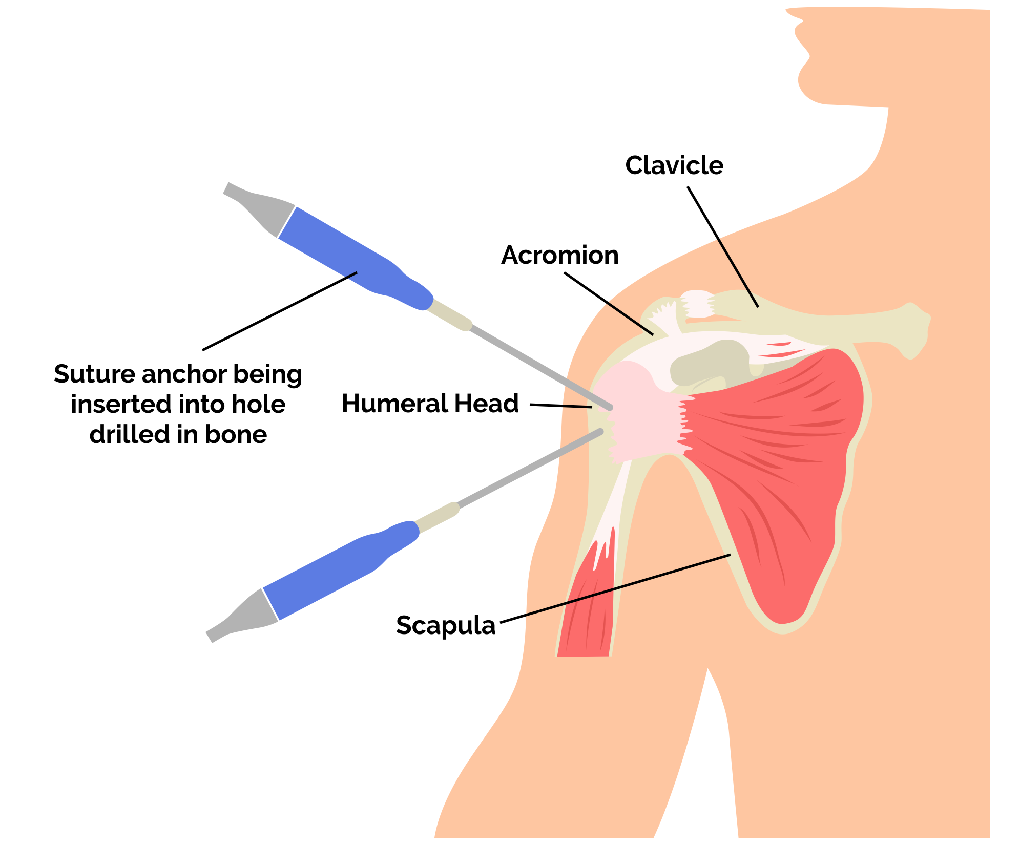 Precision Arthroscopic Bankart Repair - Treat Shoulder Instability