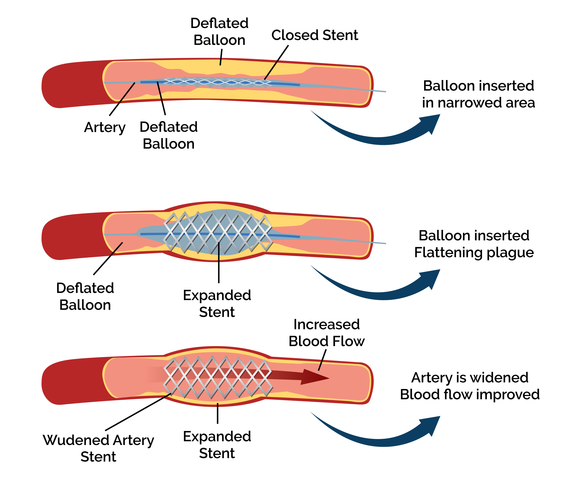 Advanced Balloon Angioplasty & Stenting Surgery