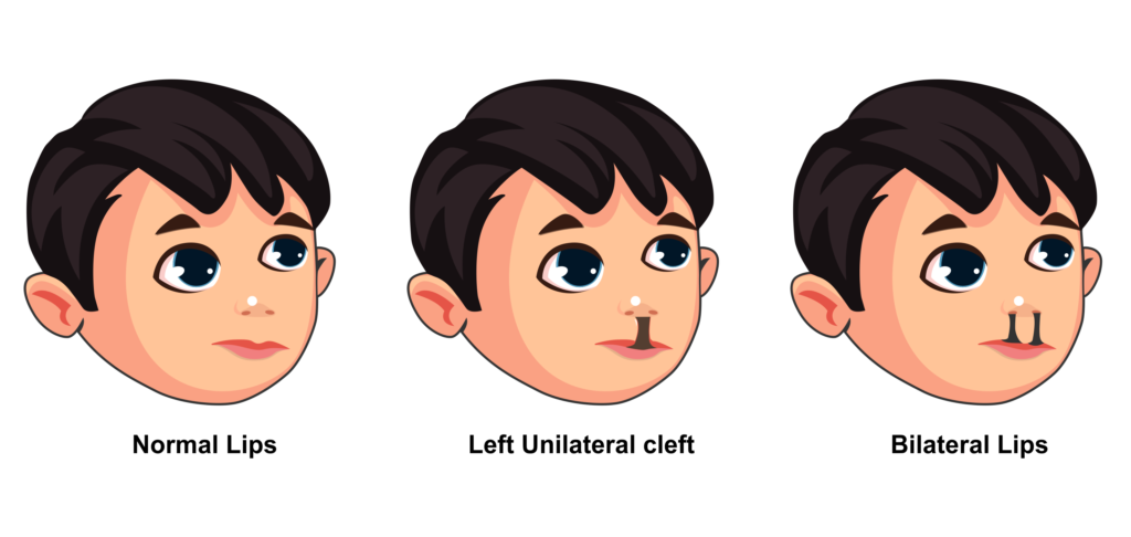 Expert Care for Cleft Lip and Palate Correction | Treatians