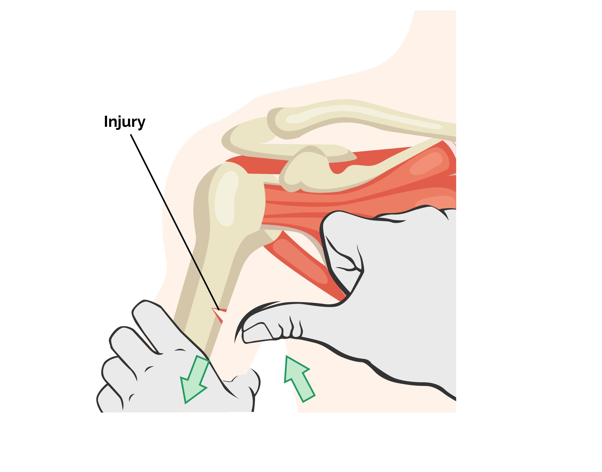 Close Reduction of Fractures & Dislocations | Treatians