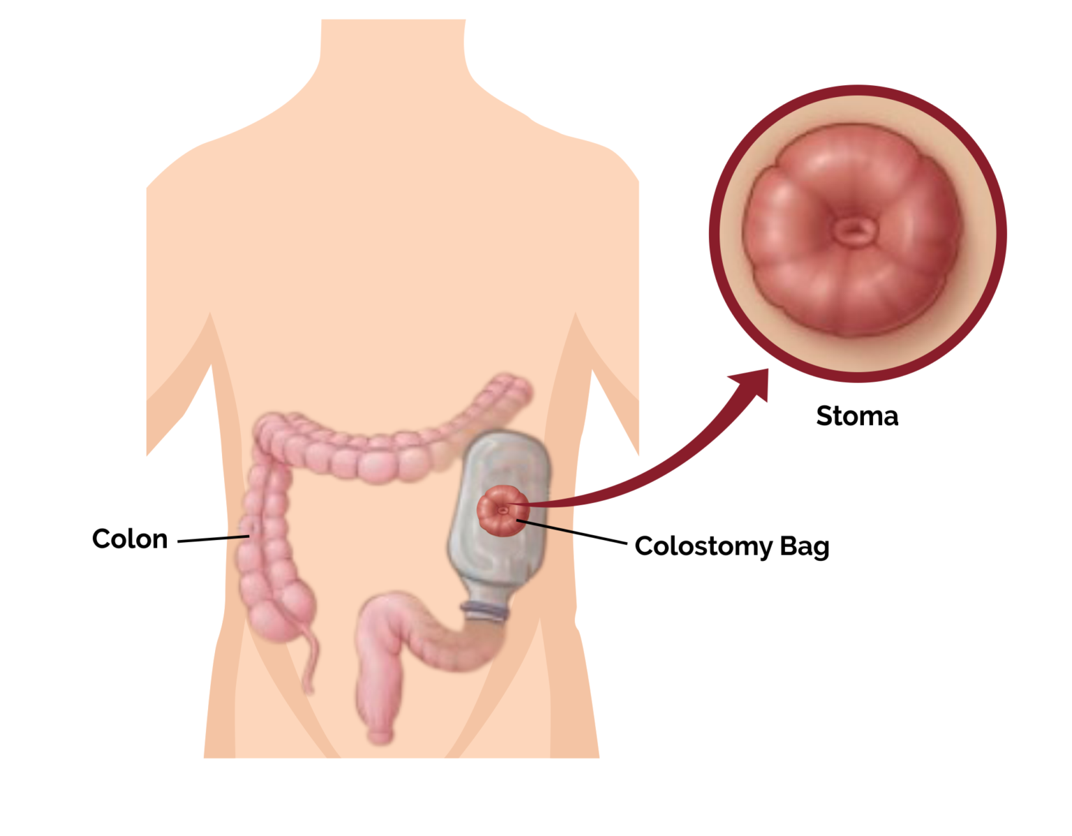 Optimal Health through Laparoscopic Total Colectomy