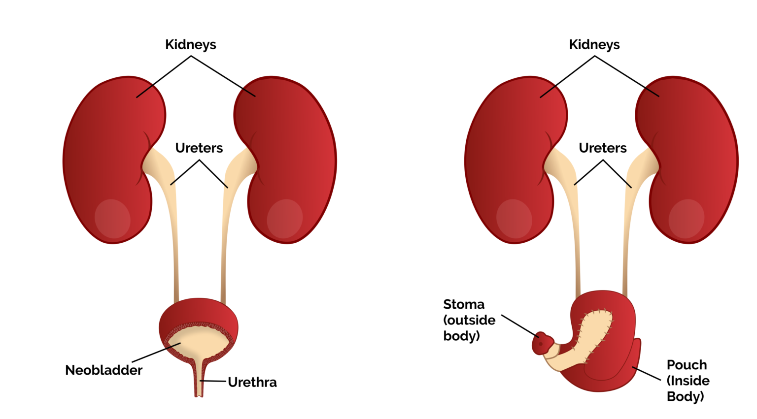 Laparoscopic Radical Cystectomy - Treatians
