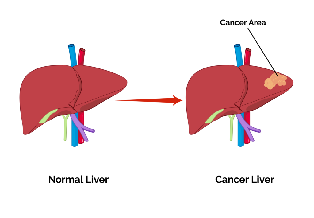 Liver Cancer Care | Treatians | oncology