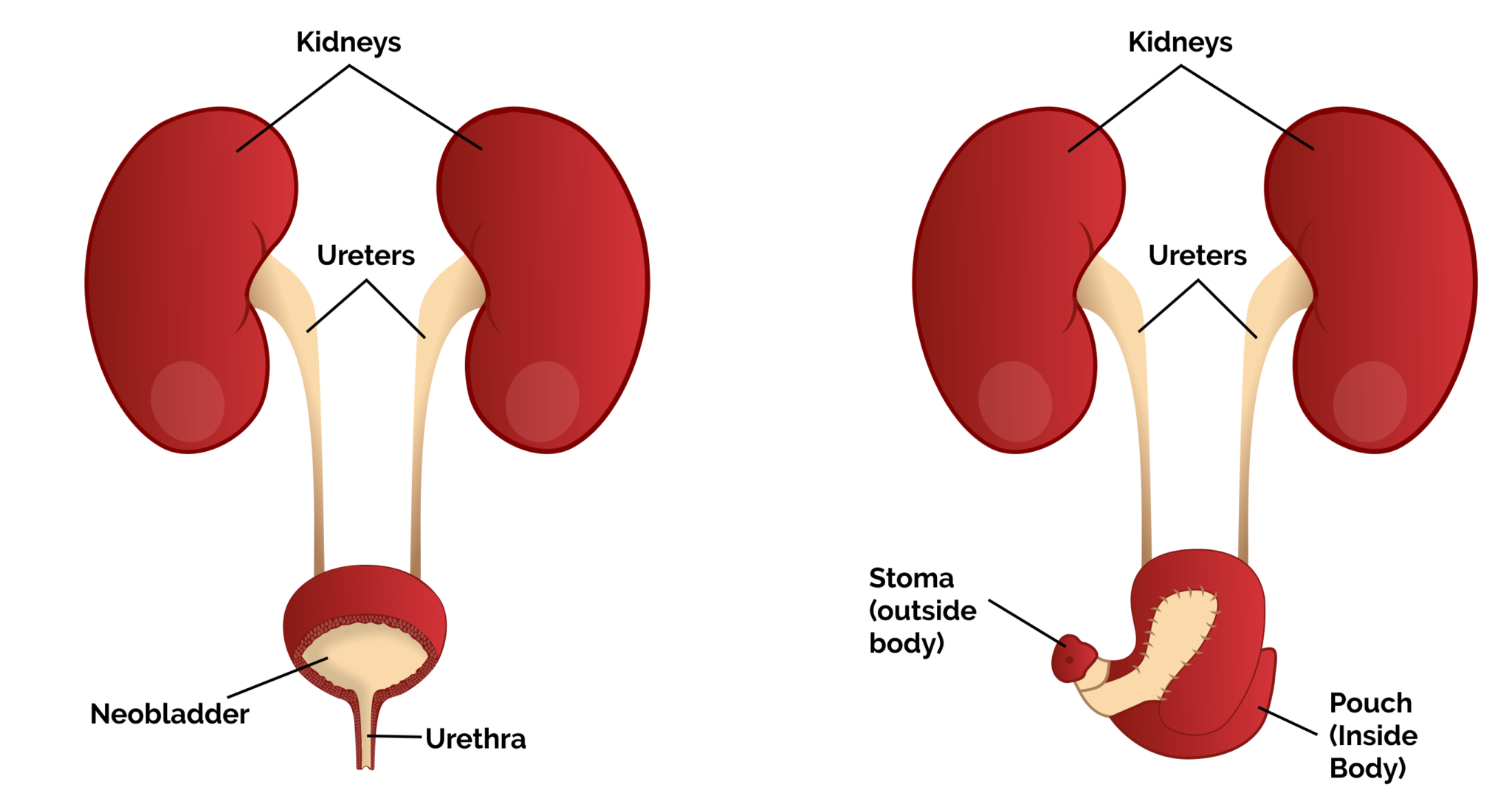 Open Radical Cystectomy: Surgical Procedure
