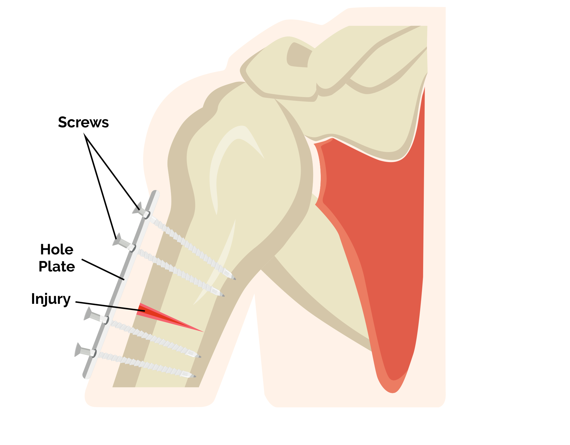 Optimal Healing With Open Reduction And Internal Fixation