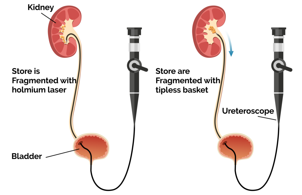 Effective RIRS Treatment for Urological Conditions