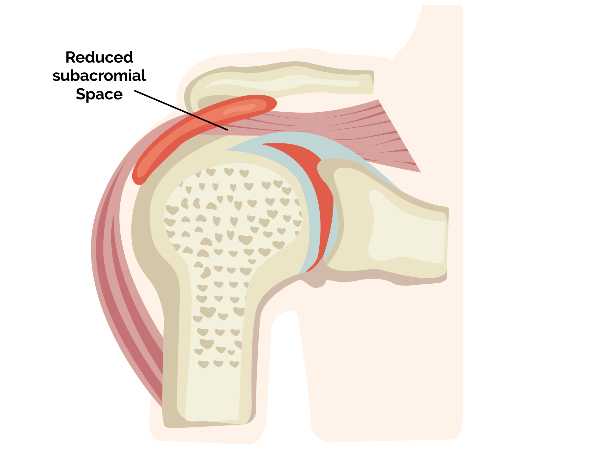 Shoulder Arthroscopy & Sub-Acromial Decompression - Treatians