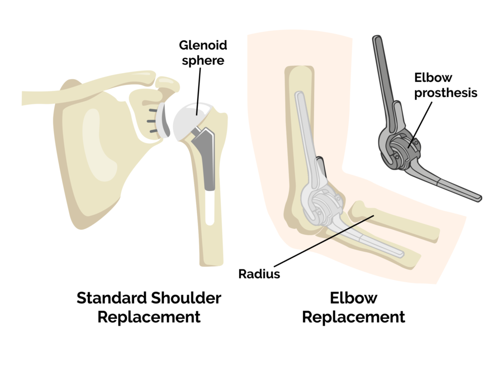 Shoulder & Elbow Replacement Surgery-Treatians Orthopaedics