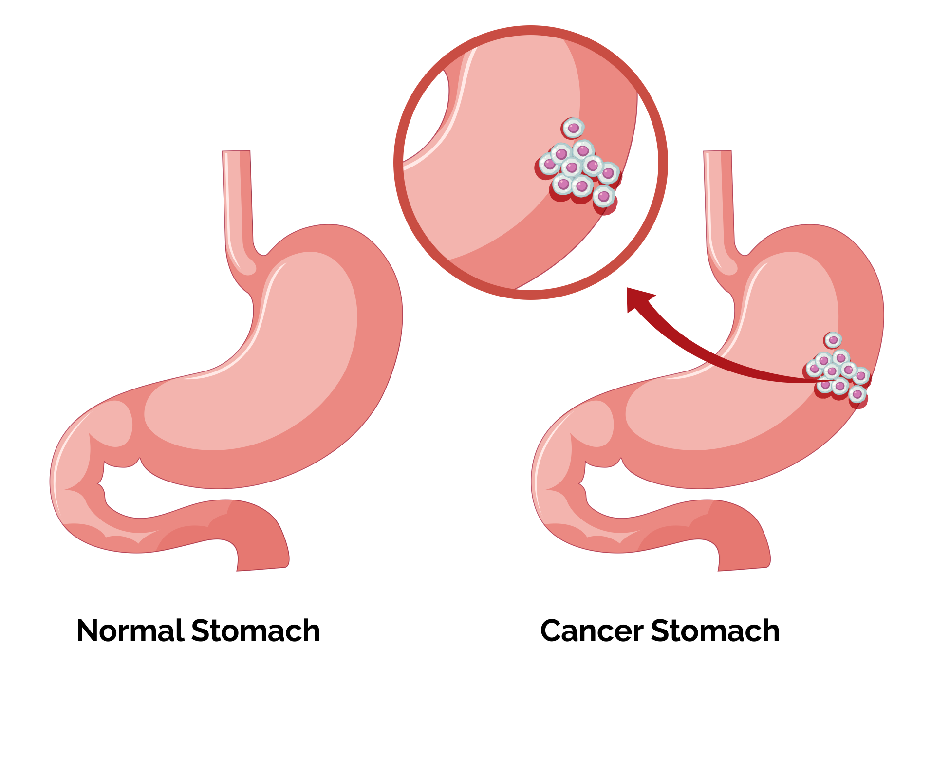 Stomach Cancer Diagnosis & Treatment