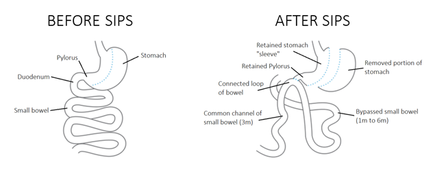 Advanced Stomach Intestinal Pylorus Sparing (SIPS) Surgery