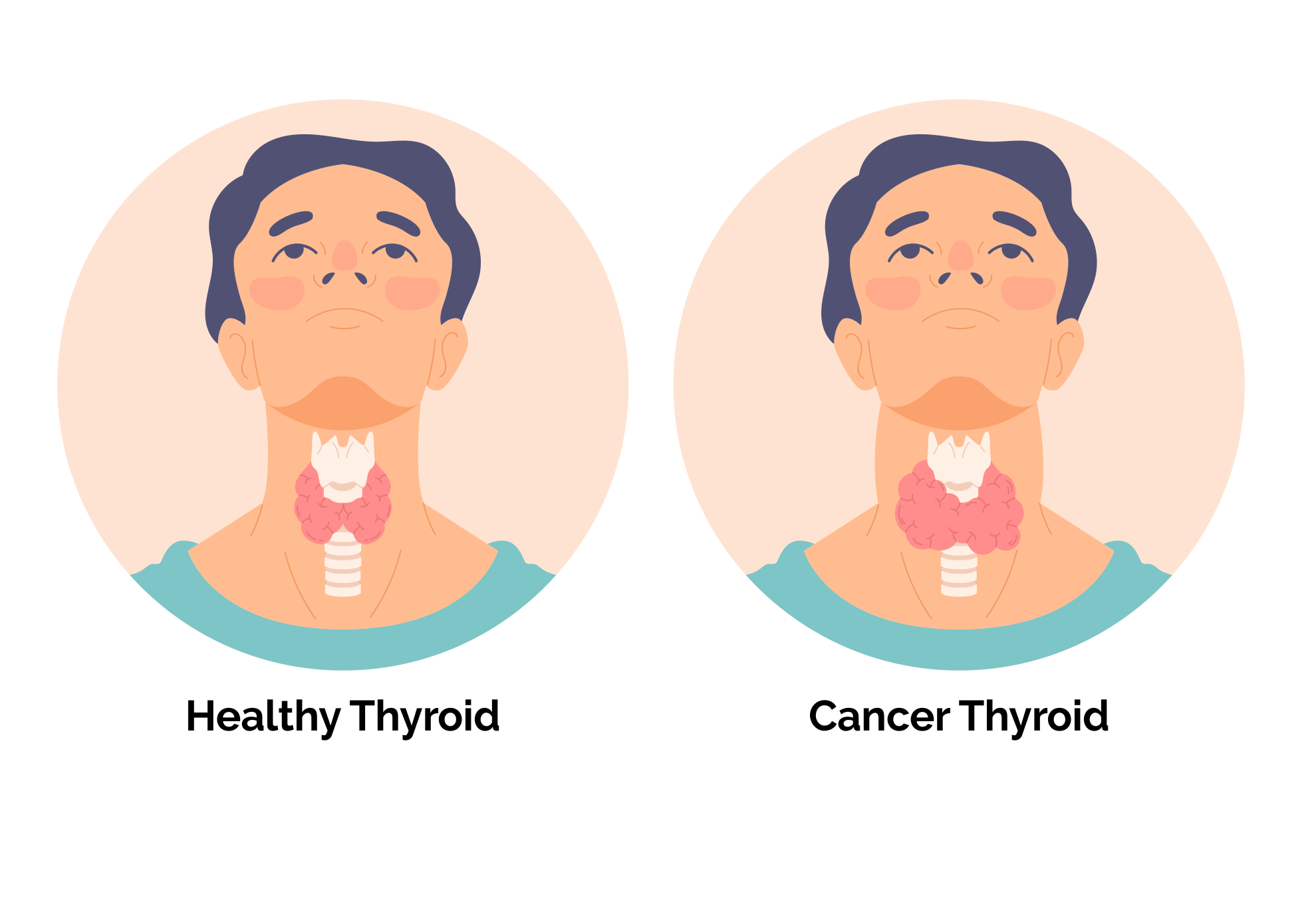 Thyroid Cancer Care at Treatians