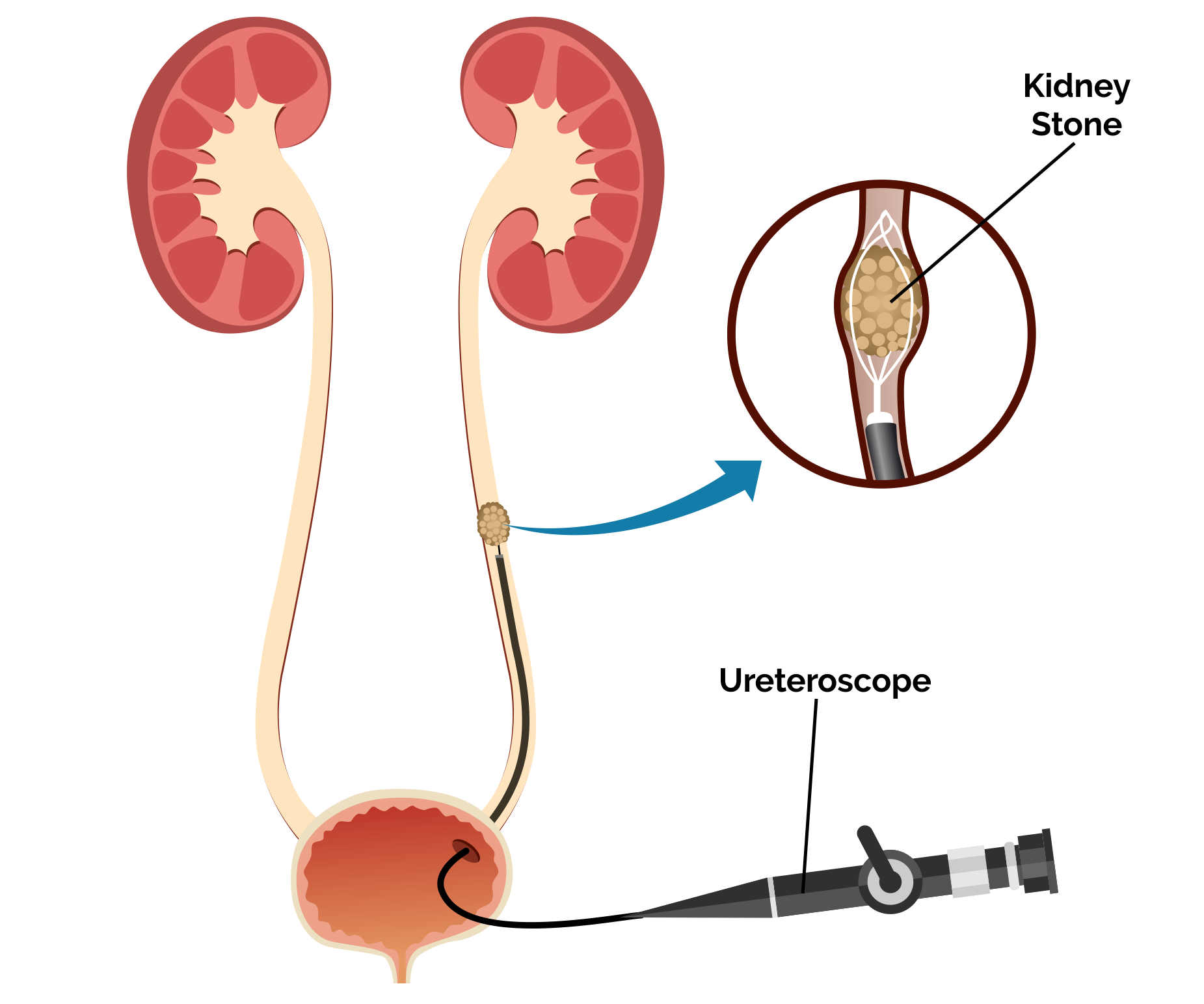Urs Ureterorenoscopy Laparoscopic Surgeon