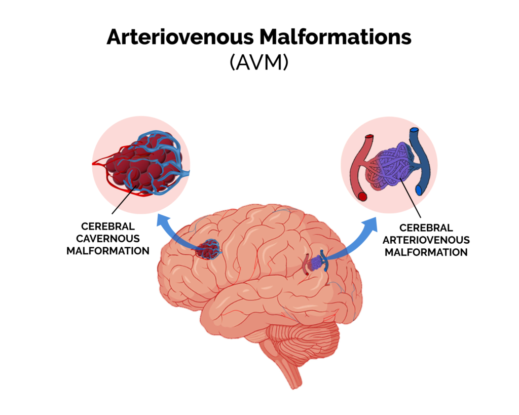 Advanced Treatment for Arteriovenous Malformations (AVM)
