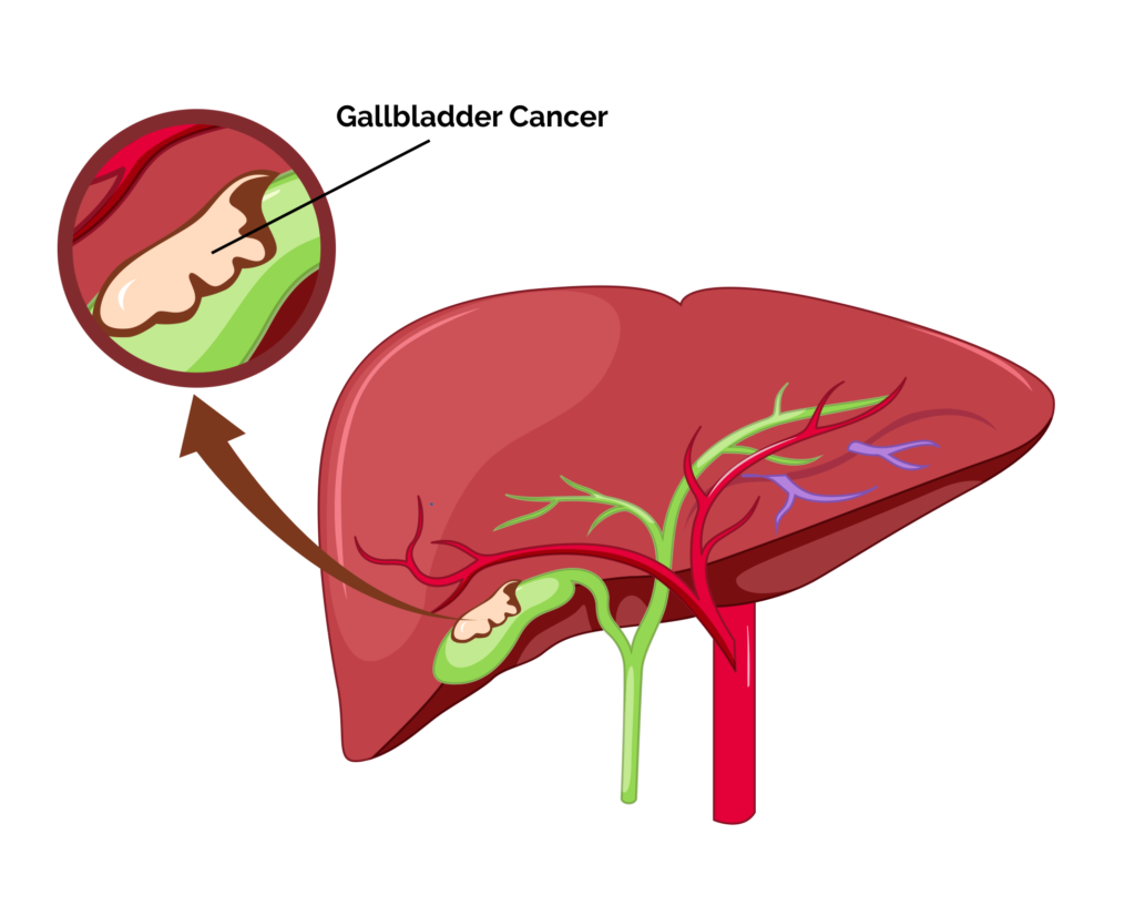 Gallbladder Cancer - Treatians