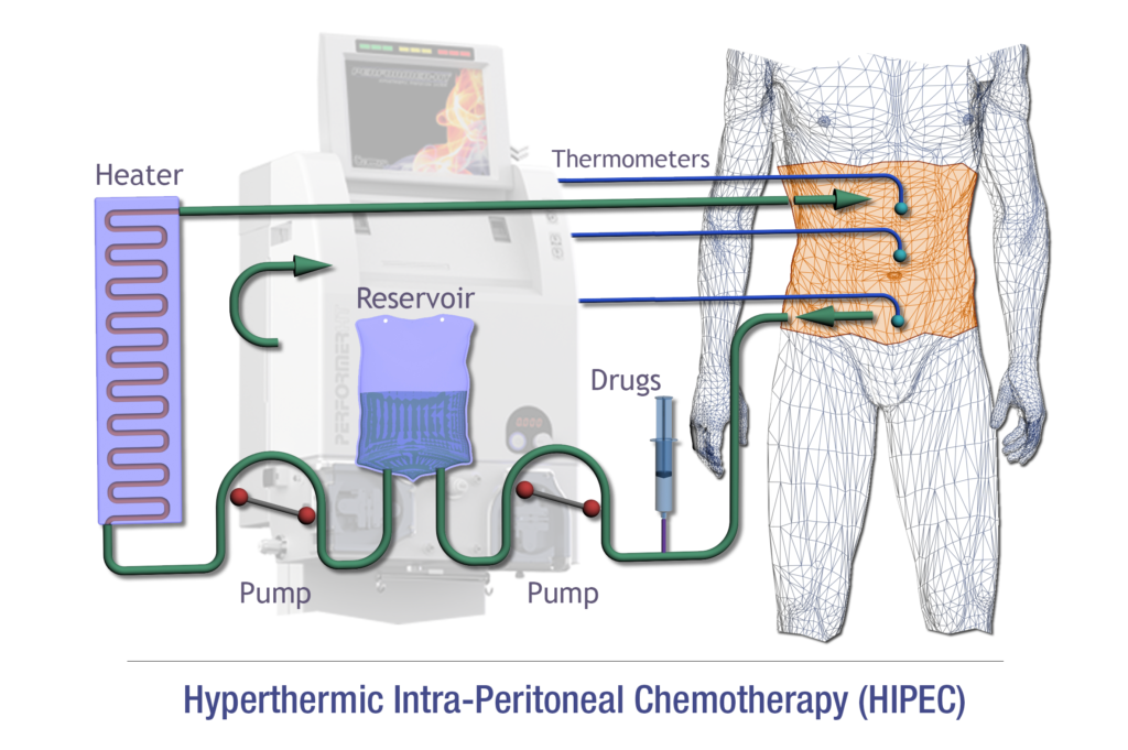 Hyperthermic Intraperitoneal Chemotherapy (HIPEC) Surgery - Treatians