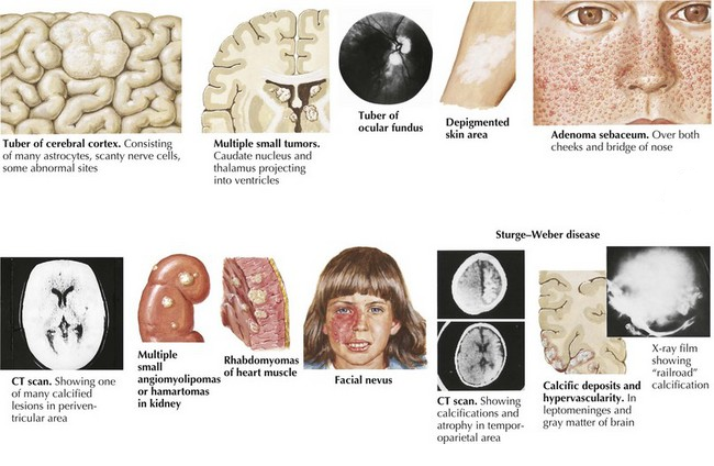 Comprehensive Care for Neurocutaneous Syndromes