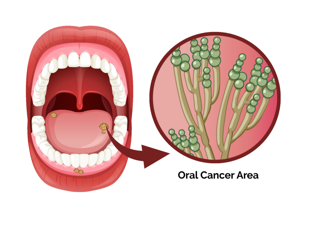 Oral Cancer - Treatians