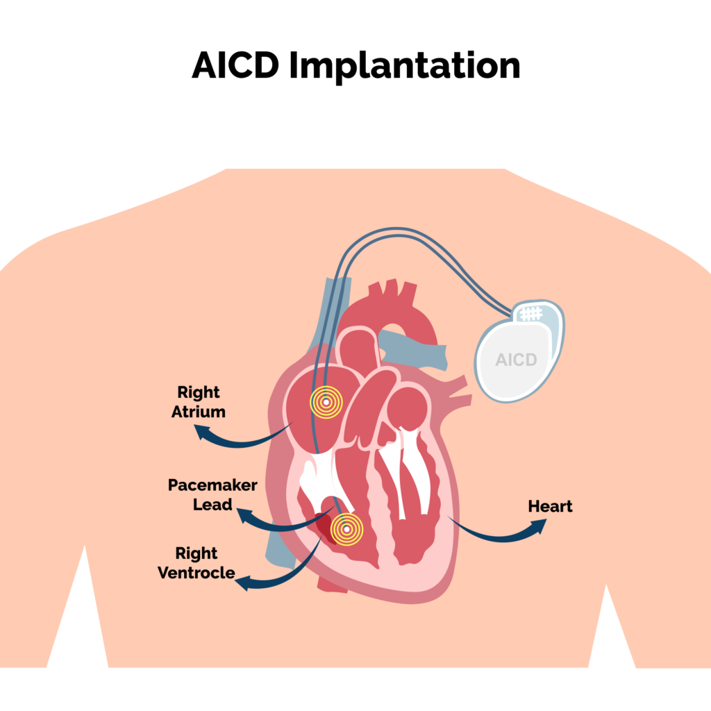 AICD Implantation - Treatians