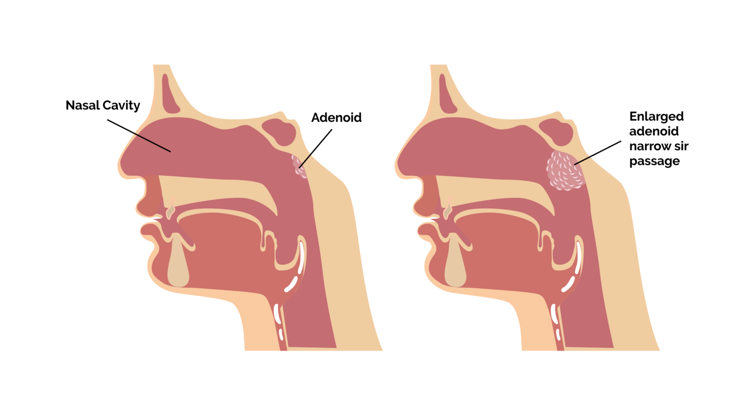Adenotonsillectomy Procedure at Treatians