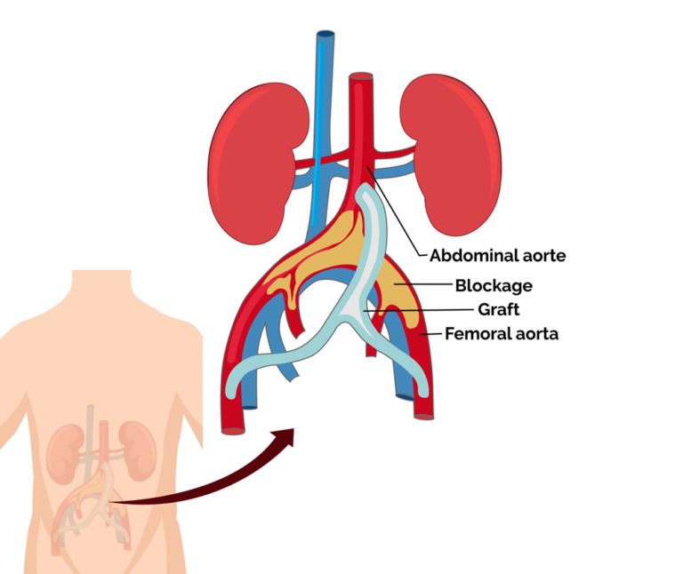 Aorta Femoral Bypass Surgery: Vascular Expertise at Treatians