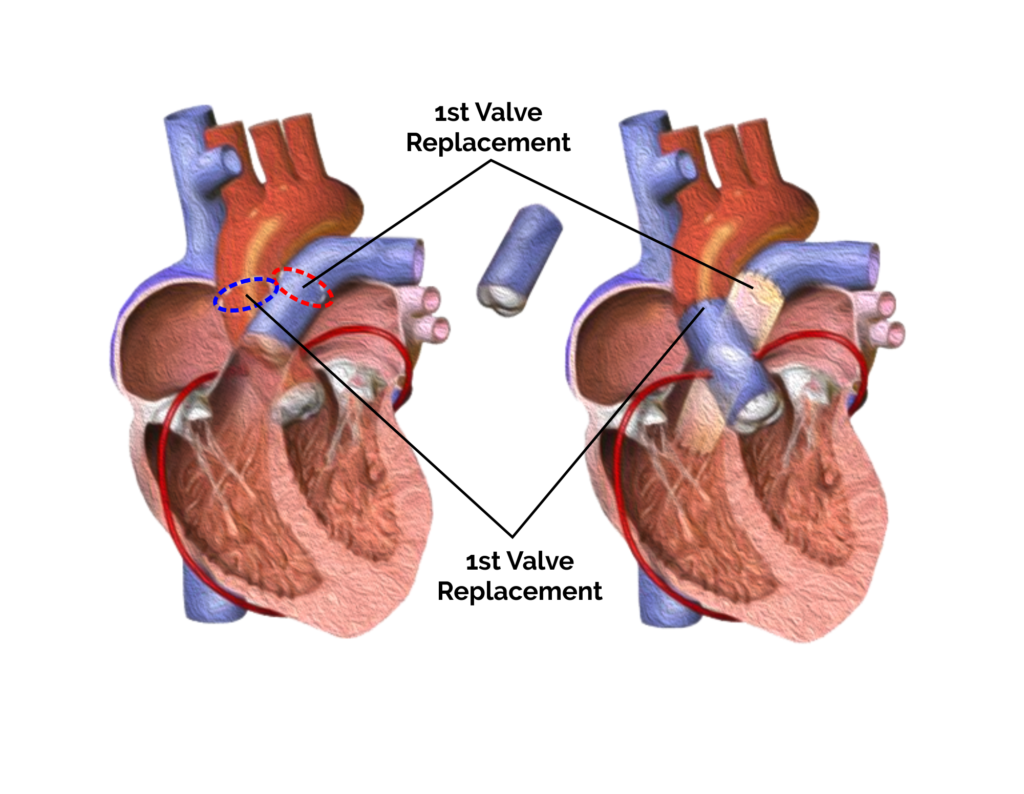 Double Valve Replacement | Including Tissue Valve