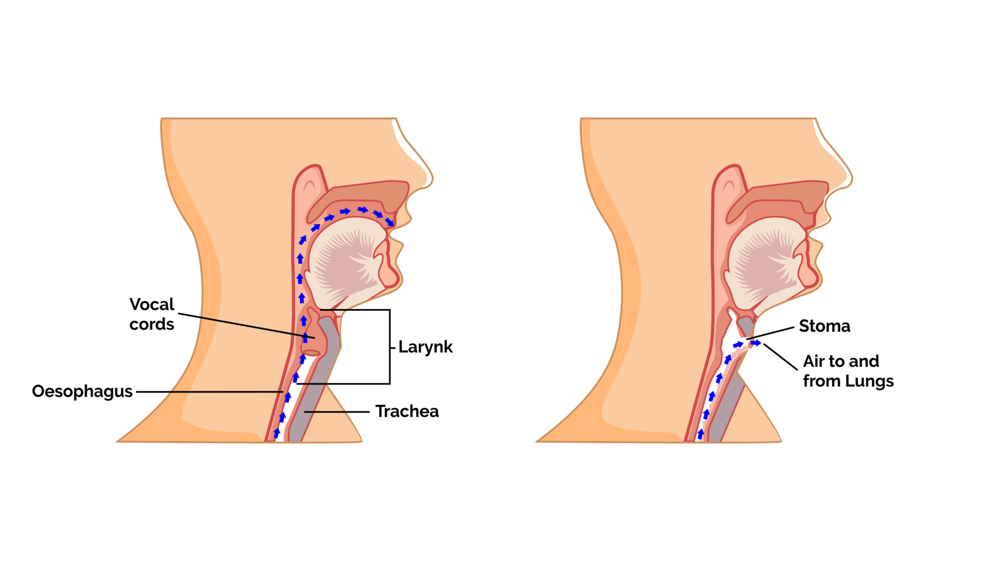 Advanced ENT Services for Laryngeal Health-Laryngectomy
