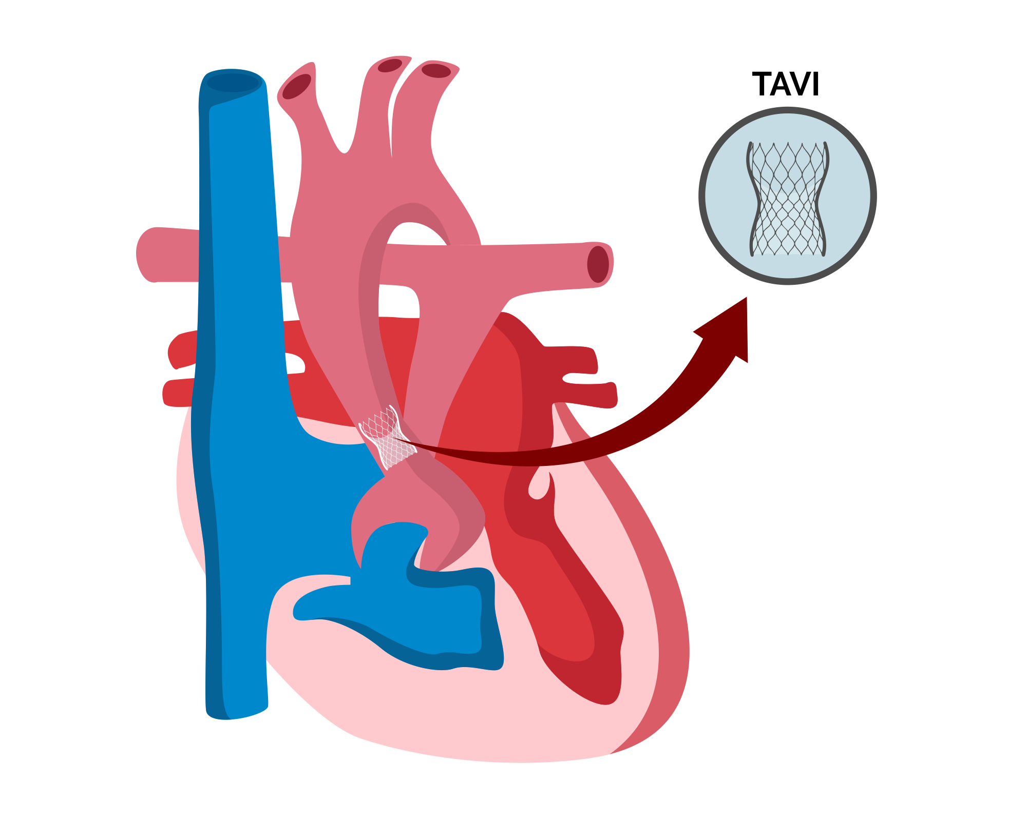 Transcatheter Aortic Valve Implantation Procedure( TAVI)