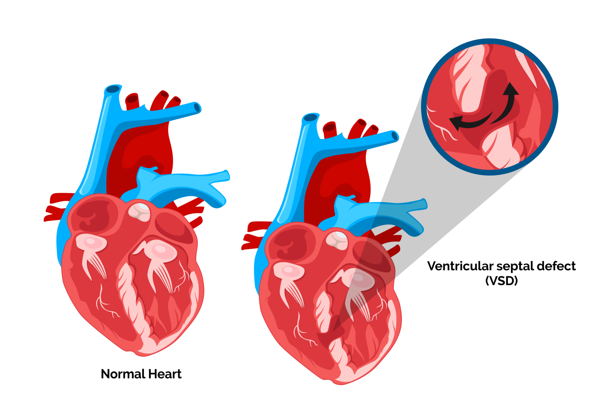 Advanced Adult Ventricular Septal Defect (VSD) Closure Surgery