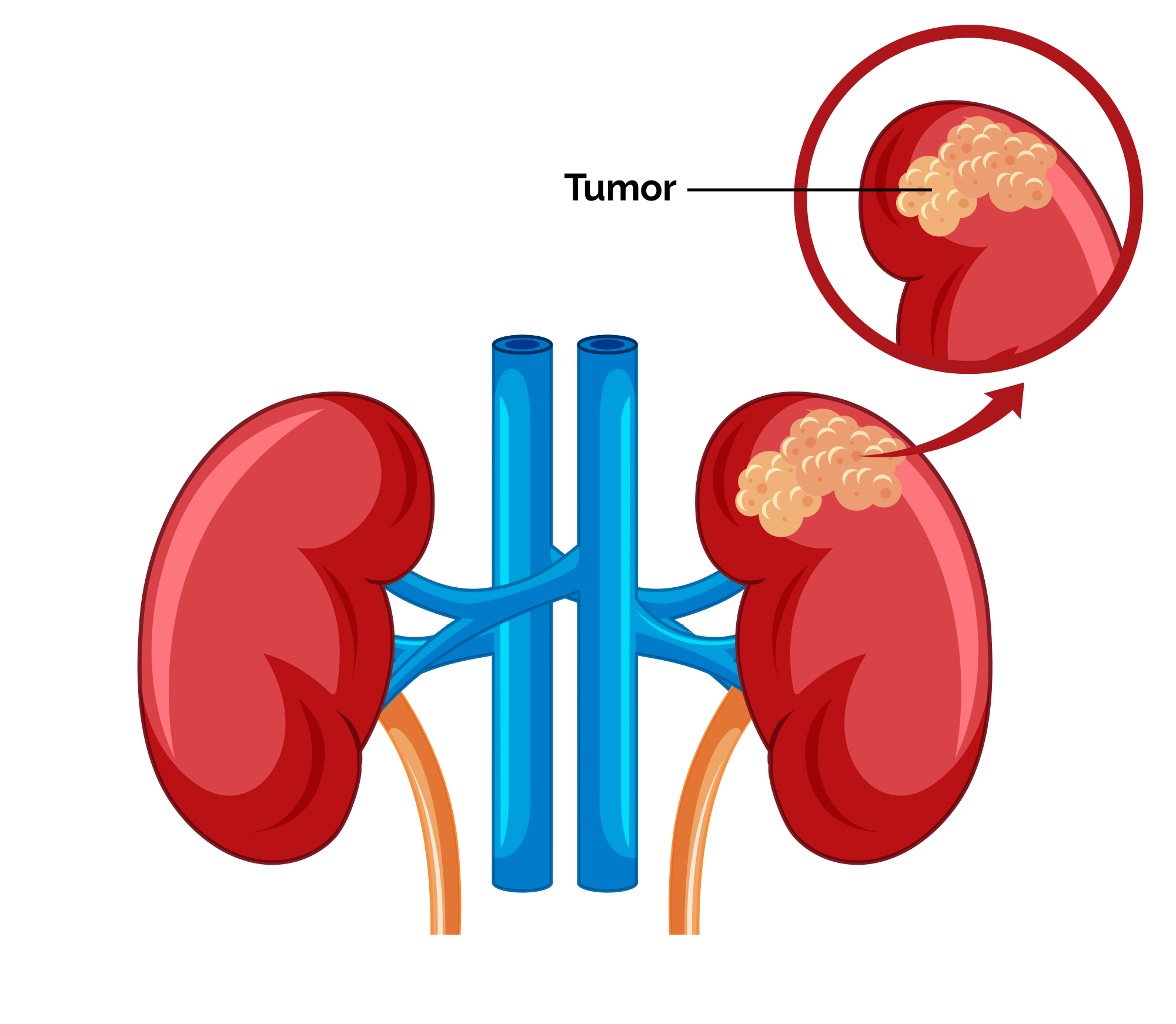 Expert Wilms Tumor Treatment | Treatians